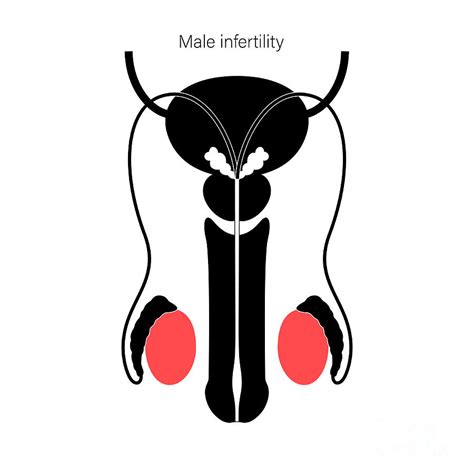 Male Infertility Photograph By Pikovit Science Photo Library Fine