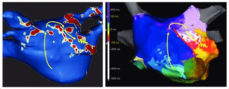 Recurrent Perimitral Flutter After Two Mitral Isthmus Ablations