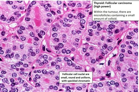 Thyroid Follicular Carcinoma Nus Pathweb Nus Pathweb