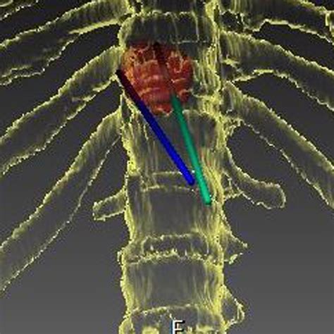 Neuwave Redefining Ablation Ethicon