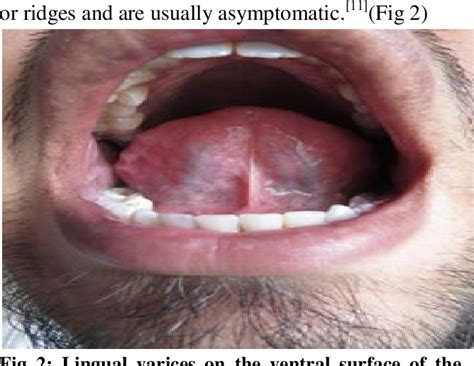 Lingual Varicosities Cause