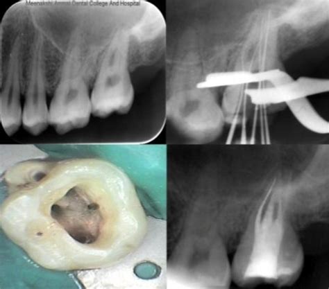 Endodontic Management Of Maxillary Second Molars Fused With Paramolar