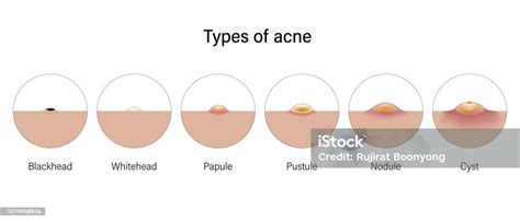 피부 문제 여드름 유형 여드름 화이트 헤드 구진 농포 결절 및 낭종 아름다움과 치료에 대 한 광고에 대 한 벡터입니다 사람들에 대한 스톡 벡터 아트 및 기타 이미지 Istock