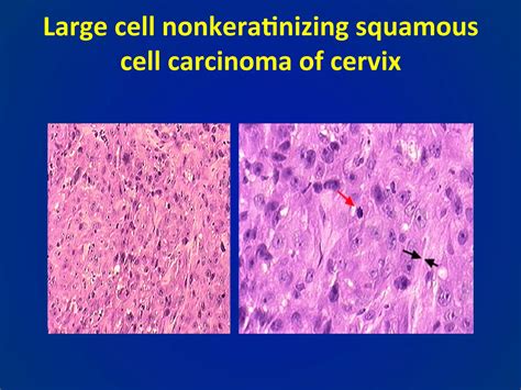 Carcinoma Of Cervix Pathology Pdf