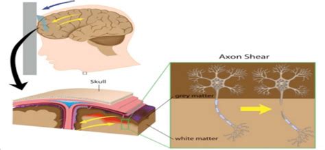 Diffuse Axonal Injury Mechanism