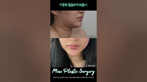 날씬하고 예쁜 제 턱선 보실래요😍 이중턱 이중턱근육묶기 Shorts Youtube