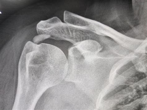 How Is Shoulder Barbotagelavage Treating Calcific Tendonitis Done