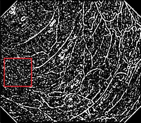 matlab noise removal in medical segmented image signal processing