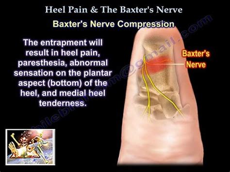 The Baxters Nerve And Plantar Fasciitis Everything You Need To Know