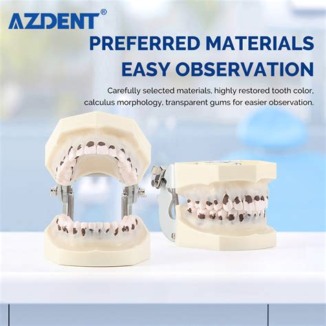 high quality dental calculus exercise model with subgingival calculus