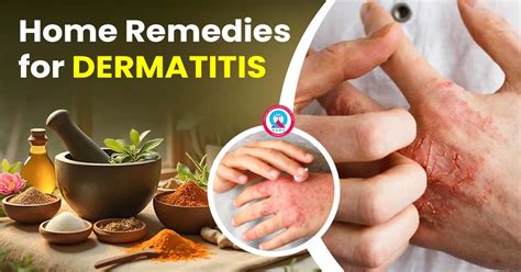 Home Remedies For Dermatitis Soothe Your Skin Naturally