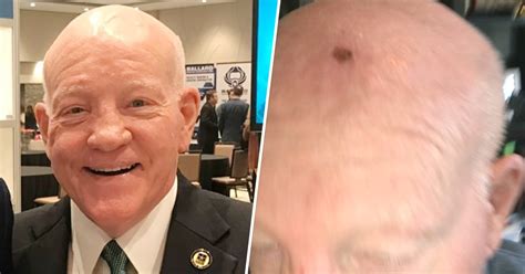 Melanoma Symptoms Pimple On Scalp Was Skin Cancer