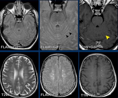 Bacterial Meningitis Brain Mri