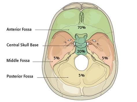 Skull Fractures Explained — Ct Findings Csf Leak And Surgery