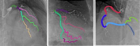 segmentation of vessel into specific regions according to the syntax