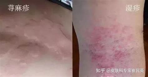 皮肤有疙瘩，如何辩证是什么病？教你如何区分湿疹、荨麻疹？ 知乎