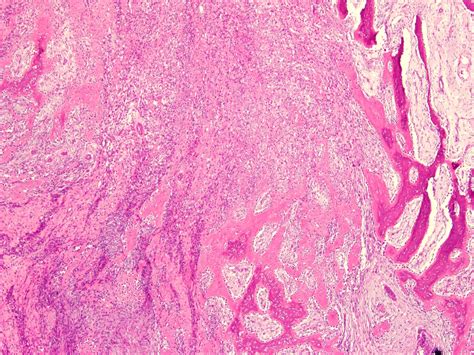 Ossifying Fibroma Pathology Outlines
