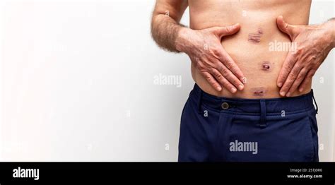 Template Laparoscopic Appendectomy Surgery Scars Care In Abdomen Area