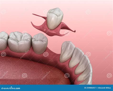 Partial Removable Immediate Denture Type Butterfly Replacement Of One