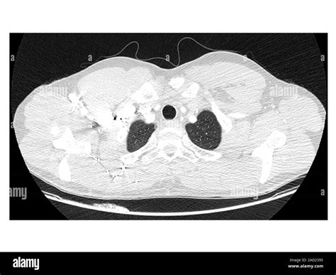 Illustration Of The Lungs Pulmonary Segmentation In Thoracic Ct This