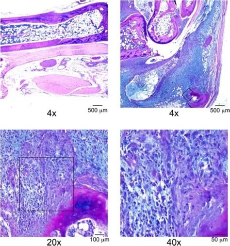 What Is Lyme Arthritis Pathosomes