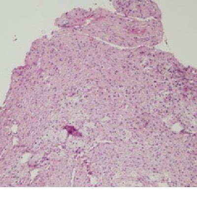 Lytic Peripherally Sclerotic Lesion With Well Defined Borders In The Download Scientific