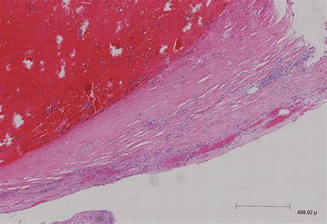 Photomicrograph Of The Excised Abscess Wall Download Scientific Diagram