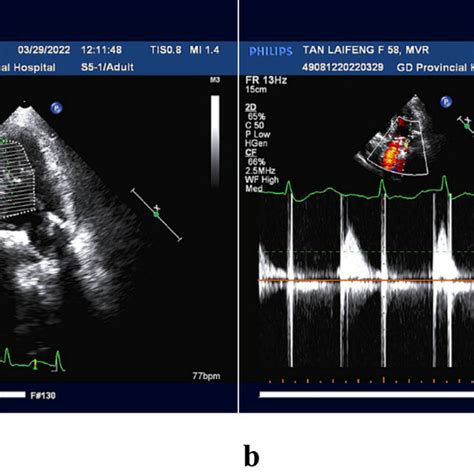 The Echocardiogram In One Month Follow Up Showed That The Composite