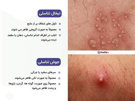 تبخال تناسلی در مردان علائم، علت و درمان عکس