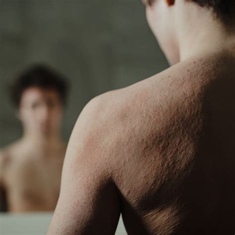 7 Different Types Of Psoriasis SBR Network Business And Networking Insights