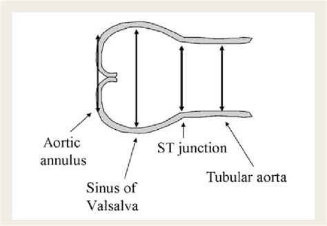 Typical Measurements Of The Aortic Root Apparatus St Sinotubular