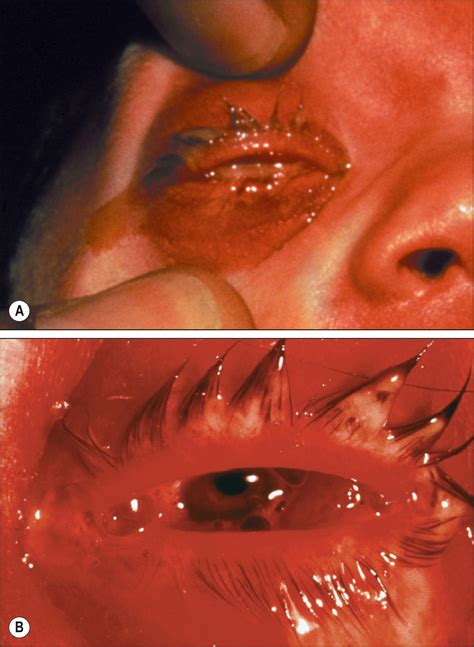Ophthalmia Neonatorum Clinical Tree