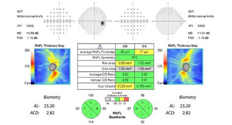 The Initial Visual Field A B And Optical Coherence Tomography OCT Download Scientific