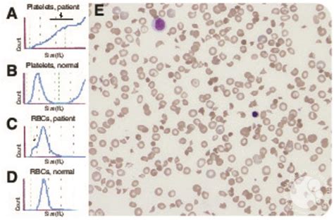 Red Cell Fragments Can Mask Severe Thrombocytopenia