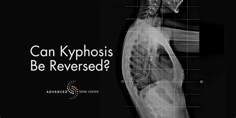 Can Kyphosis Be Reversed Advanced Spine Center Plano Tx