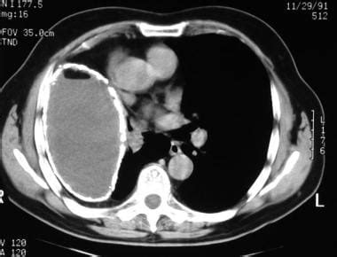 Empyema Imaging Practice Essentials Radiography Computed Tomography