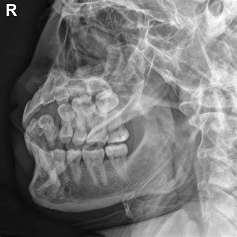 Mandibular Fracture 4 Buyxraysonline