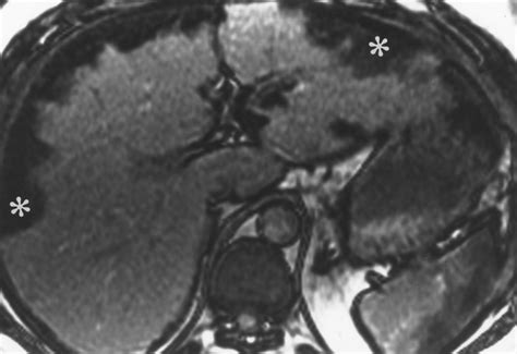 Unusual Patterns Of Hepatic Steatosis Caused By The Local Effect Of Insulin Revealed On Chemical