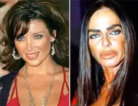 Celebrities Before And After Plastic Surgery Gone Wrong 60 Photos