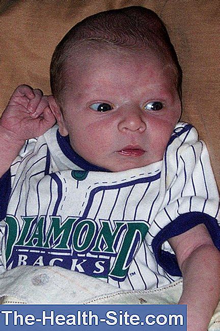 Cephalhematom Årsaker Symptomer Frekvens Behandling 💊 Scientific