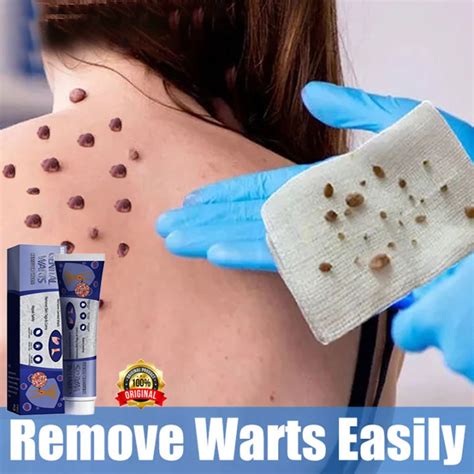 Wart Removal Wart Flat Wart Removal Ointment Small Meat Grains On The