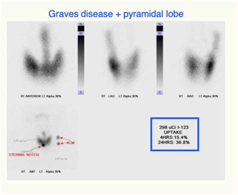 Physiology Of Hyperthyroidism Flashcards Quizlet