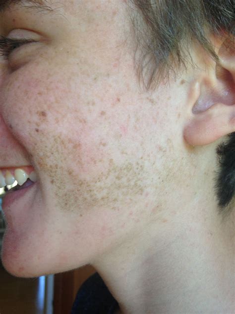 Dermatitis Neglecta Feet At Kimberly Borges Blog