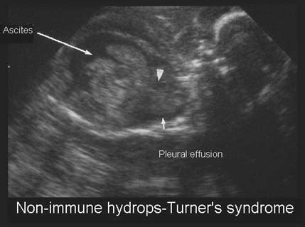 Hydrops Ultrasound