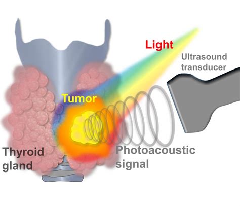 Thyroid Ultrasound Nodule