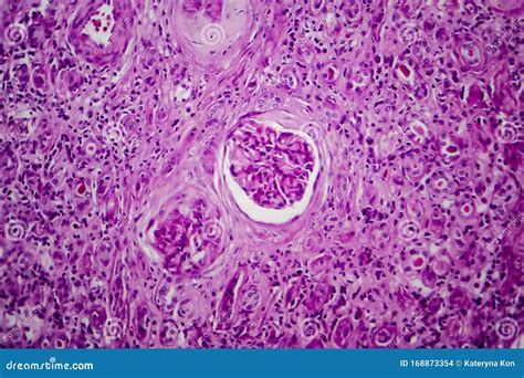 Glomerulonephritis Histologie Rapid Progressive Glomerulonephritis