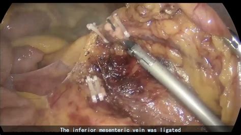 Laparoscopic Assisted Transvaginal Radical Sigmoidectomy For Sigmoid
