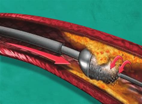 B Technique Of Rotational Atherectomy Download Scientific Diagram