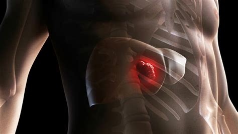 Sex Age Racial And Ethnic Disparities Persist In Clinical Trial Enrollment For Liver Cancer