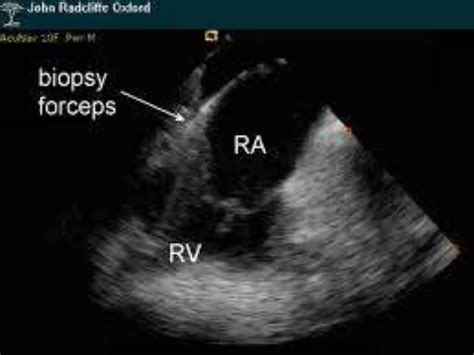 An Approach To Myocardial Biopsy Interpretation Ppt